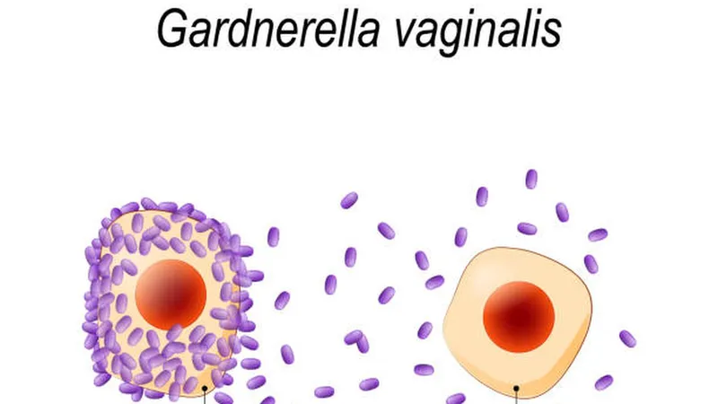 Gardnerella vaginalis và bệnh viêm âm đạo: chuẩn đoán điều trị