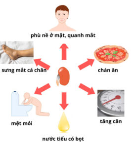 Các giai đoạn của bệnh lupus ban đỏ hệ thống gây tổn thương thận