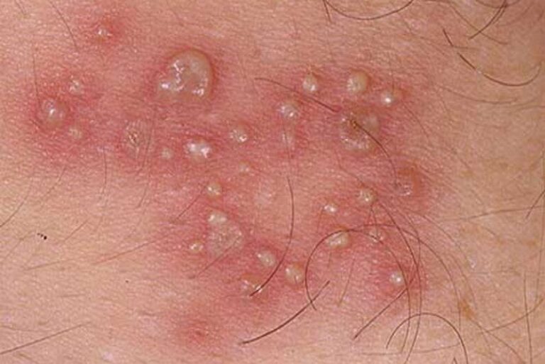 Biến chứng bệnh herpes sinh dục
