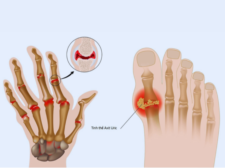 Thuốc điều trị gout Febuxostat: Công dụng, liều dùng và lưu ý khi dùng ...