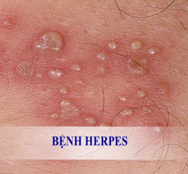 Herpes – Bệnh sinh dục cần biết