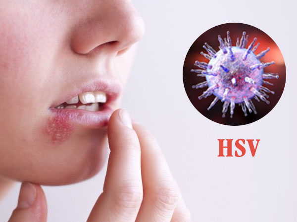 Ai dễ mắc bệnh Herpes sinh dục?