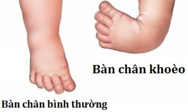 Bàn chân khoèo là gì? Những điều cần biết về bàn chân khoèo