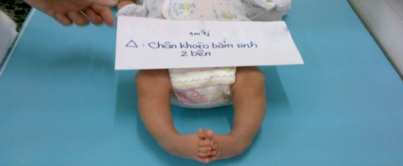 Bàn chân khoèo là gì? Những điều cần biết về bàn chân khoèo
