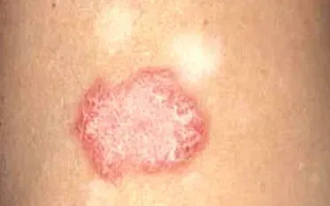 Bệnh lupus ban đỏ: nguyên nhân, dấu hiệu và cách điều trị hiệu quả