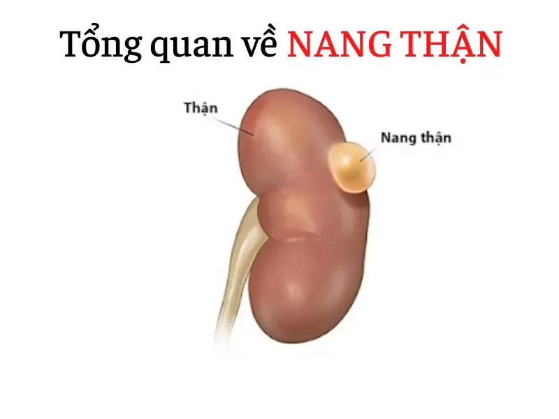 Nang thận: những hiểu biết quan trọng để bảo vệ sức khỏe thận