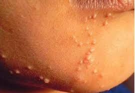 Giải pháp toàn diện để đối phó với u mềm lây: hiểu biết, phòng ngừa và ...