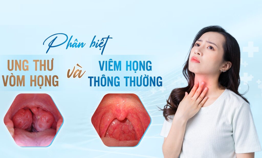 Phân biệt ung thư vòm họng và viêm họng