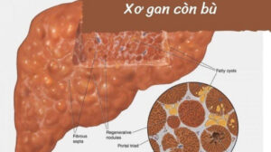Xơ gan còn bù là gì? Những điều cần biết về xơ gan còn bù